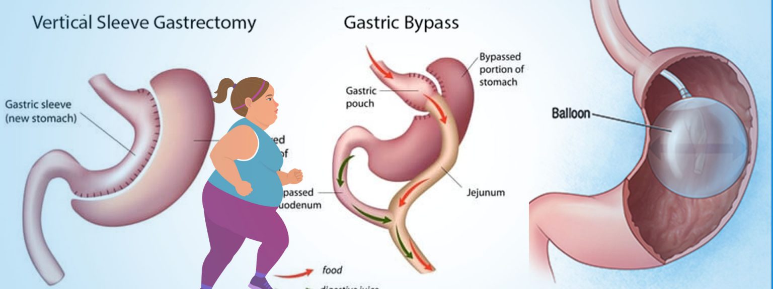 Gastric Sleeve Surgery - Turkey Istanbul Medical