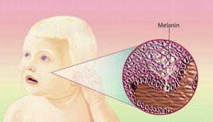 What is Albino (Albinism)? - Turkey Istanbul Medical